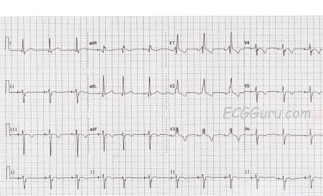 Atrial Pacing With Right Bundle Branch Block | ECG Guru - Instructor ... Atrial Pacing With Right Bundle Branch Block | ECG Guru - Instructor ...