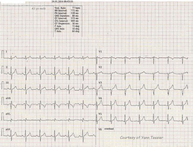 The 12 Lead Ecg Shows A Typical Atrial Flutter With Regular And Images